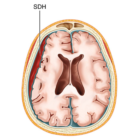 NeoCast™ - Arsenal Medical